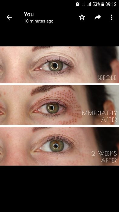 PLASMA PEN. Cauterizare alunite, negi, riduri. Bucuresti Sectorul 5 ...