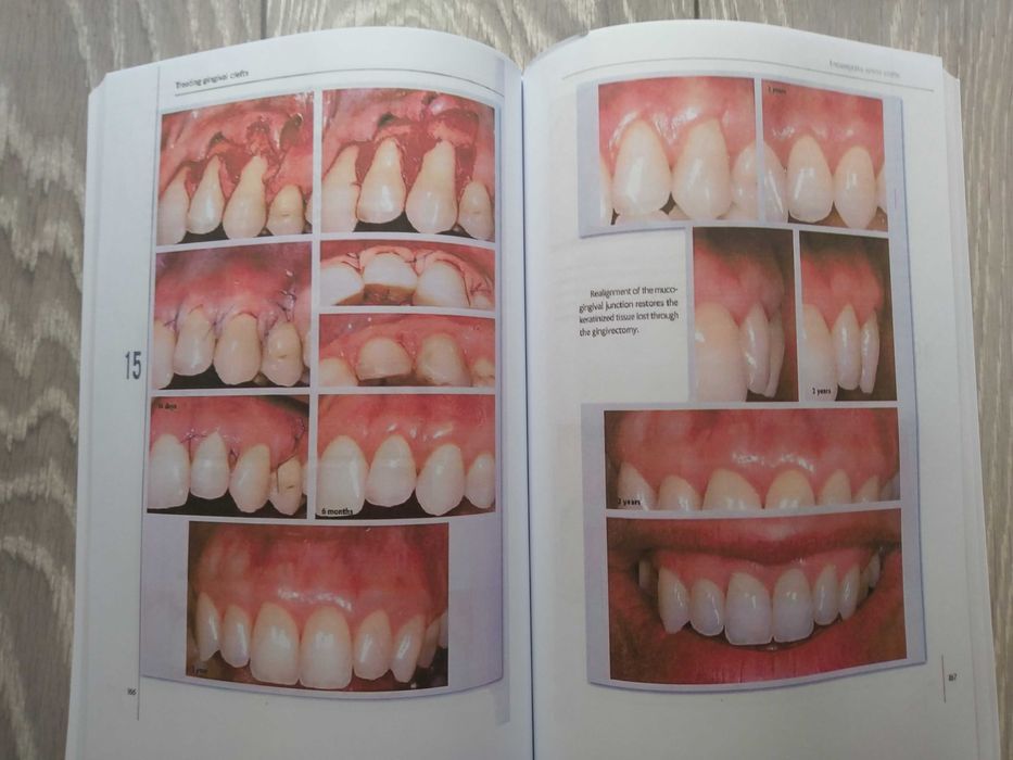 Mucogingival Esthetic Surgery - Giovanni Zucchelli - 1 Edition 2012 ...