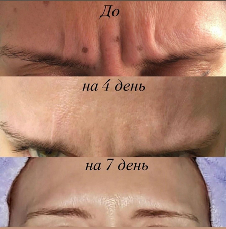 Ботокс. Фулл фэйс