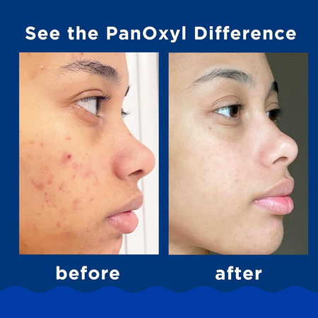 Пенка для умывания PanOxyl. Проверенное средство  от прыщей. США.