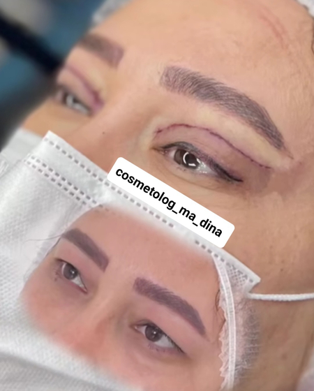 1 oy Skidkada Blefaraplastika ,browlifting, Nitevoy Sangapuri