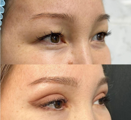 Browlifting, blefaraplastika, Sangapuri muolajasi SKIDKADA