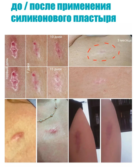Заживляющий пластырь на силиконовой основе от шрамов