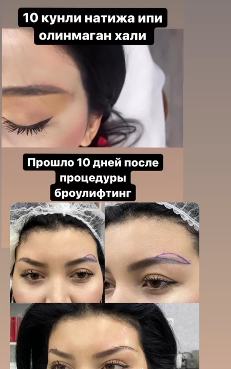 SKIDKADA (Bezoperatsonniy Sangapuri) Browlifting muolajasi