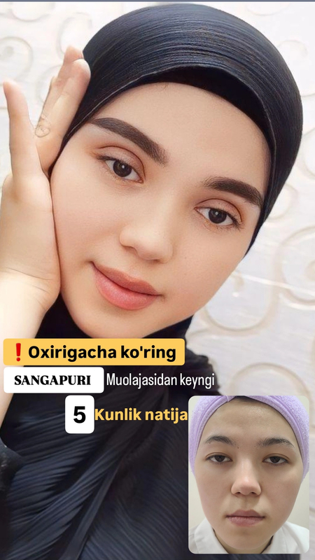 Browlifting, blefaraplastika, Sangapuri muolajasi SKIDKADA