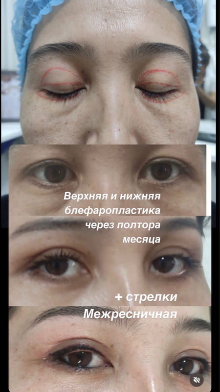 Ботох Увеличение губ блефарапластика