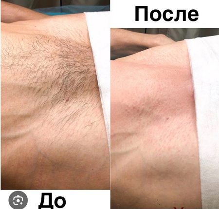 Депиляции для мужчин и женщин