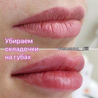 Губы бантики. Филлер гель.