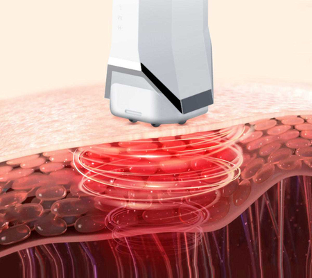 Прибор для RF-лифтинга лица и тела Xiaomi InFace RF Beauty Instrument