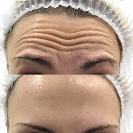 Ботокс. Фулл фэйс