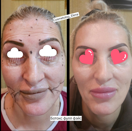 Ботокс. Фулл фэйс