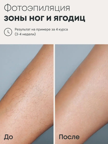 Фотоэпилятор лазерный профессиональный для удаления волос