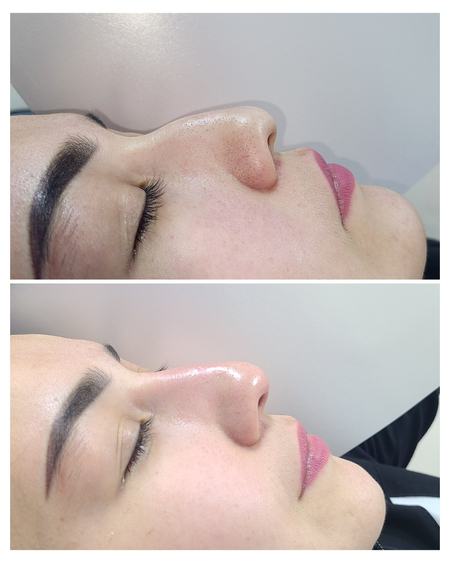 1 oy Skidkada Blefaraplastika ,browlifting, Nitevoy Sangapuri