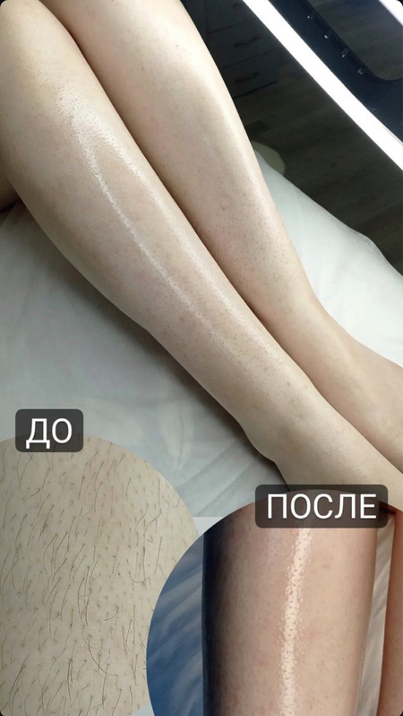 Депиляция Воском