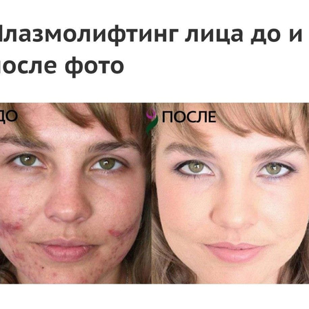 Растушевка наращивание ресниц плазмолифтинг