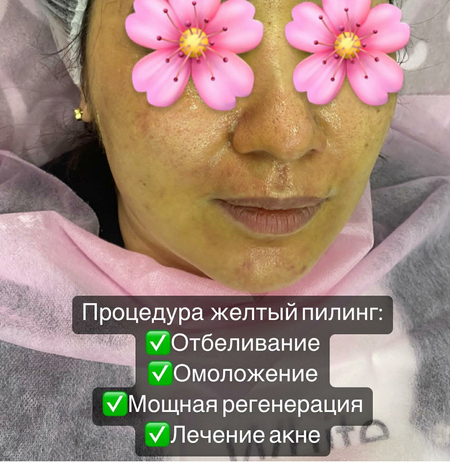 Жёлтый пилинг, косметология