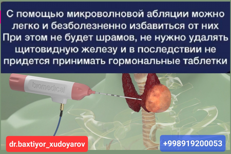 Тугунли зоб микротулкинли абляцияси(лазер ёрдамида наркозсиз кесмасиз)