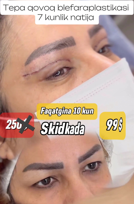 Browlifting, blefaraplastika, Sangapuri muolajasi SKIDKADA