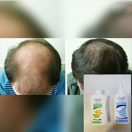 Shampoo va soch tõnik. Turkiya maxsuloti 100 ishonchli