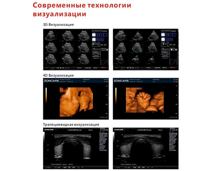 УЗИ-сканер (цифровой стационарный Zoncare-Q7)