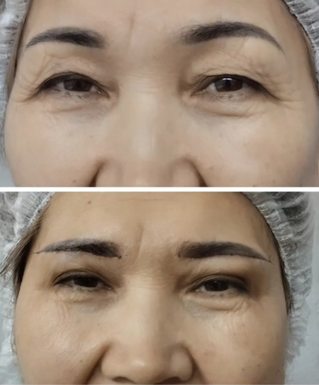 SKIDKADA (Bezoperatsonniy Sangapuri) Browlifting muolajasi