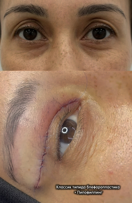 1 oy Skidkada Blefaraplastika ,browlifting, Nitevoy Sangapuri