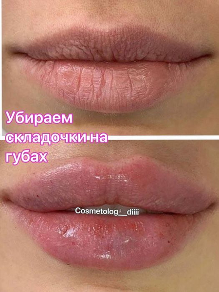 Губы бантики. Филлер гель.