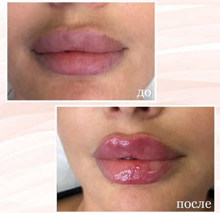 Увеличение Губ Lab Акция