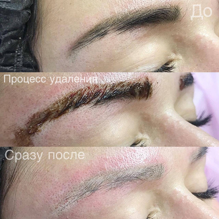 Татуаж ва растушовкаларни ремувер оркали удаления киламиз