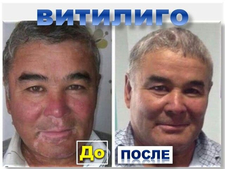 Пигментирующий лосьон от витилиго