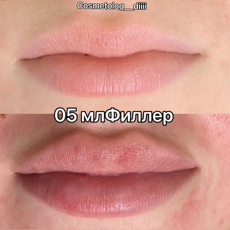 Губы бантики. Филлер гель.