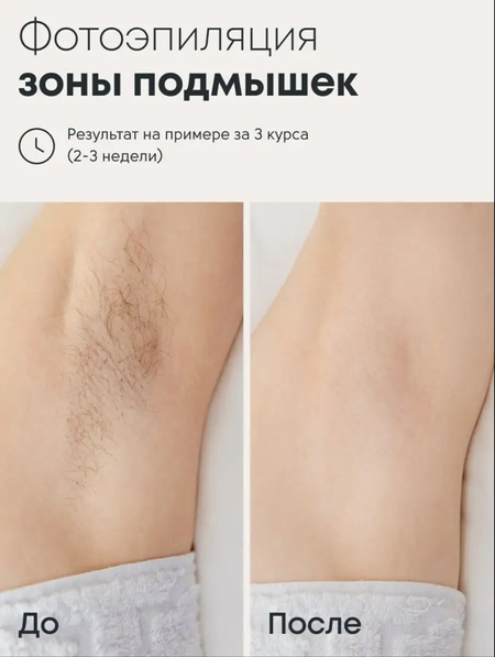Фотоэпилятор лазерный профессиональный для удаления волос