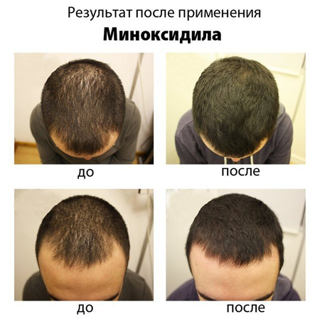 Beard oil soqol  oʻstirishni oson usuli orginali DOSTAFKA BEPUL