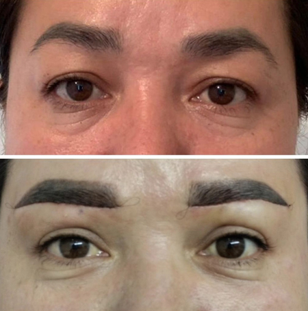 SKIDKADA (Bezoperatsonniy Sangapuri) Browlifting muolajasi