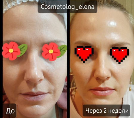 Ботокс. Фулл фэйс