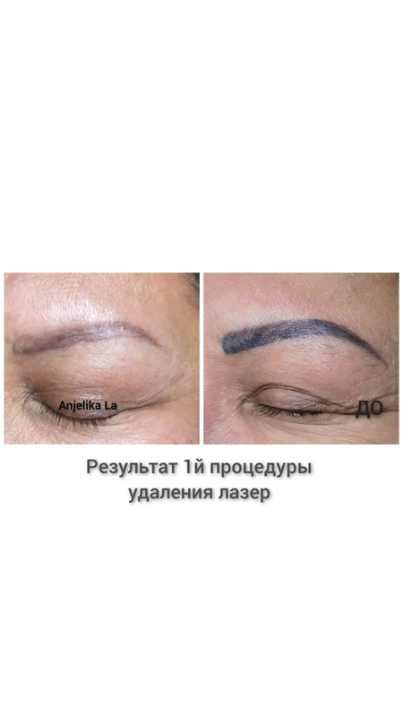 Удаление тату, татуажа неодимовым лазером