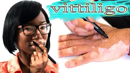 Фломастеры для витилиго, vitiligo uchun flomaster