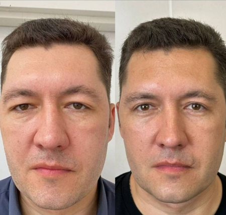 Косметология омоложения для Мужчин