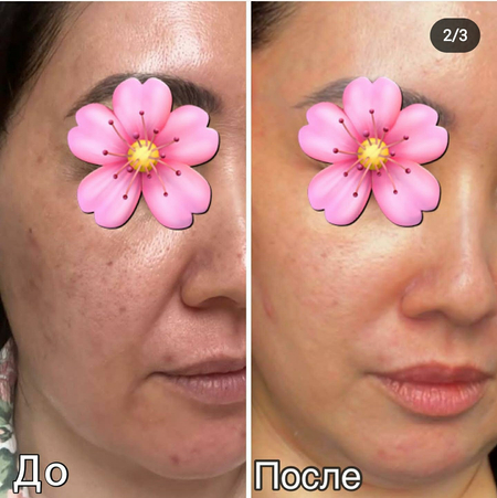 Жёлтый пилинг, косметология