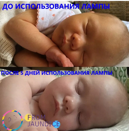 Аренда Фототерапия