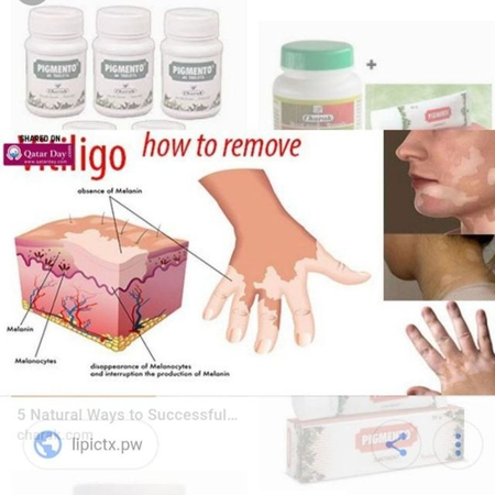 PIGMENTO Теридаги ок догларни йокотадиган ВИТИЛИГО  даволовчи.Андижон