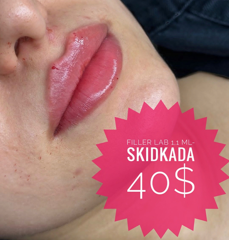 SKIDKADA Shoshiling FILLER LABGA 1,1 Koreyskiy orginal