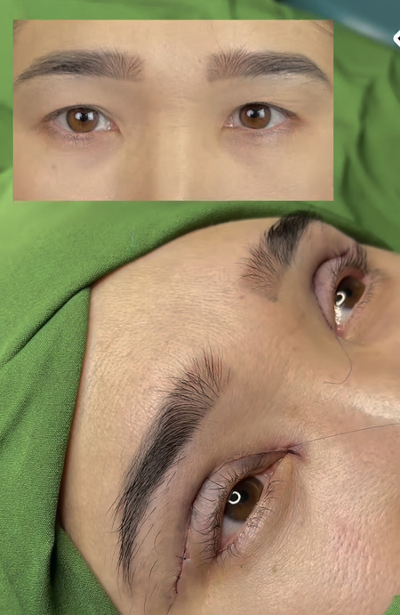 1 oy Skidkada Blefaraplastika ,browlifting, Nitevoy Sangapuri