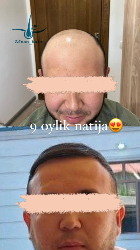 soch ekish turkiya texnalogiyasi