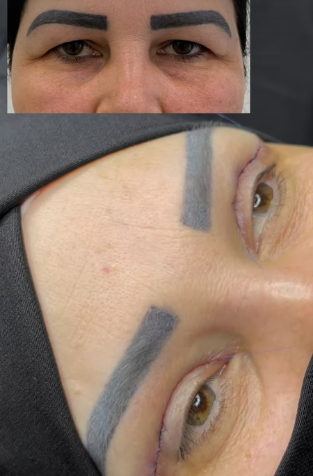 1 oy Skidkada Blefaraplastika ,browlifting, Nitevoy Sangapuri