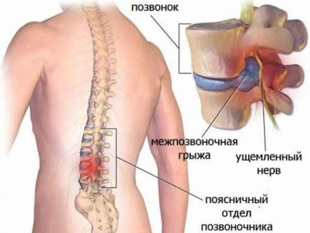 Пояснично-крестцовый корсет для грыжа спины с ремнем (26 см)