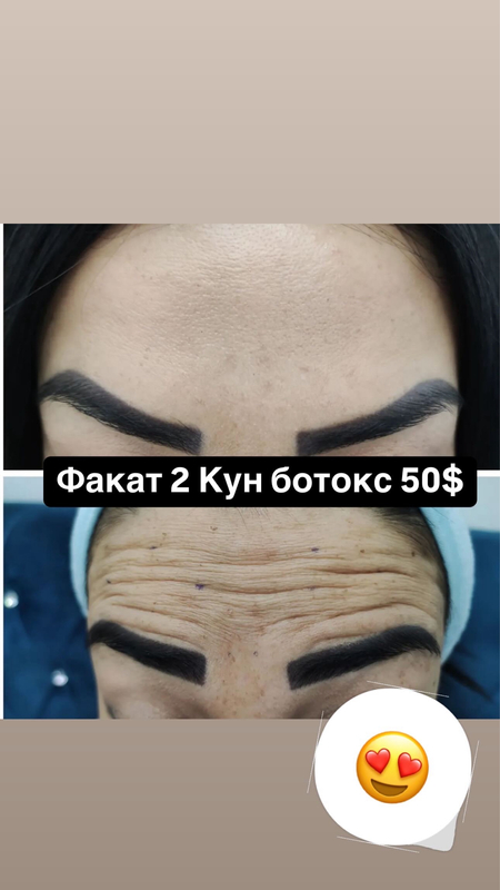 Ботокс ажинларга карши