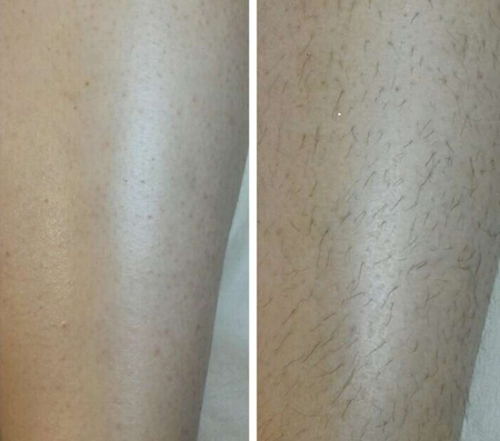 Шугаринг депиляция