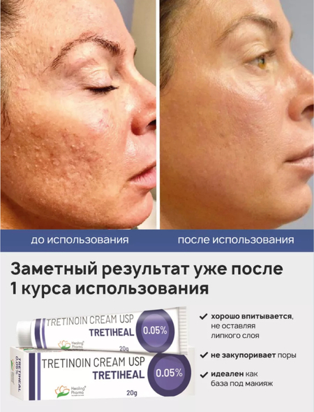 Третиноин 0.05%, антивозрастной крем против прыщей, акне, Tretin, 20 g