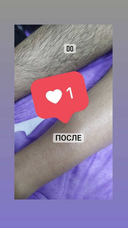Депиляция вызет на дома.